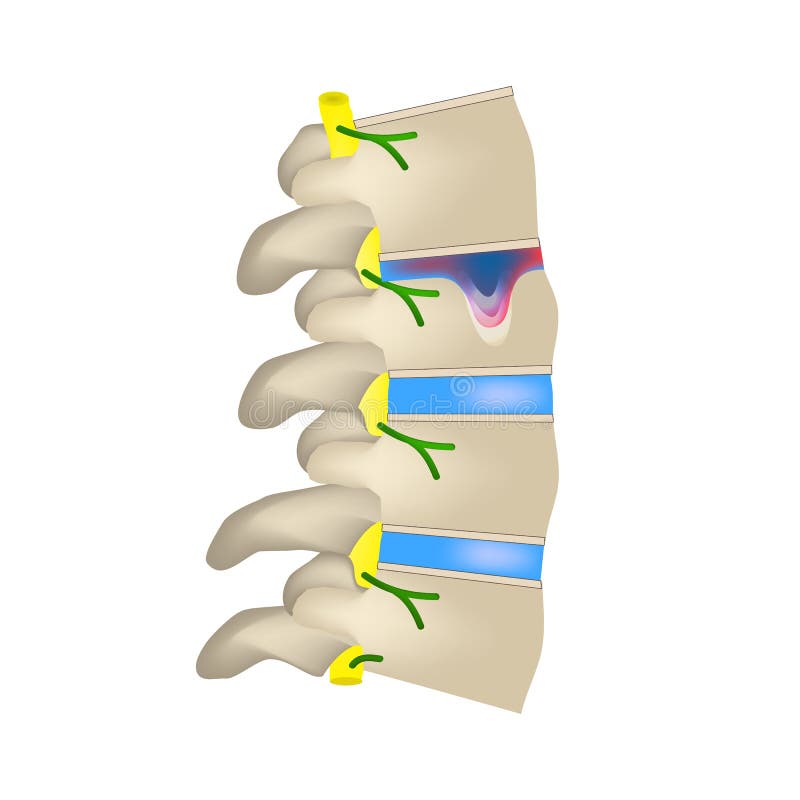 Hernia Schmorl. Intervertebral Disc. Side View. Spine. Infographics ...