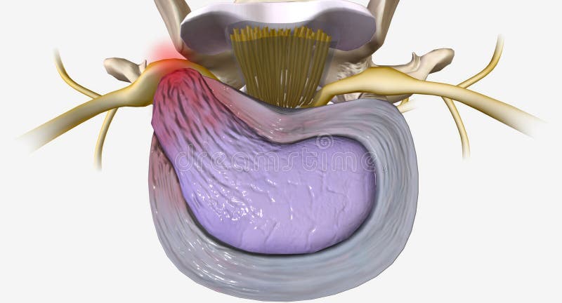 A Herniated Disc is a Condition Characterized by Structural Changes To ...