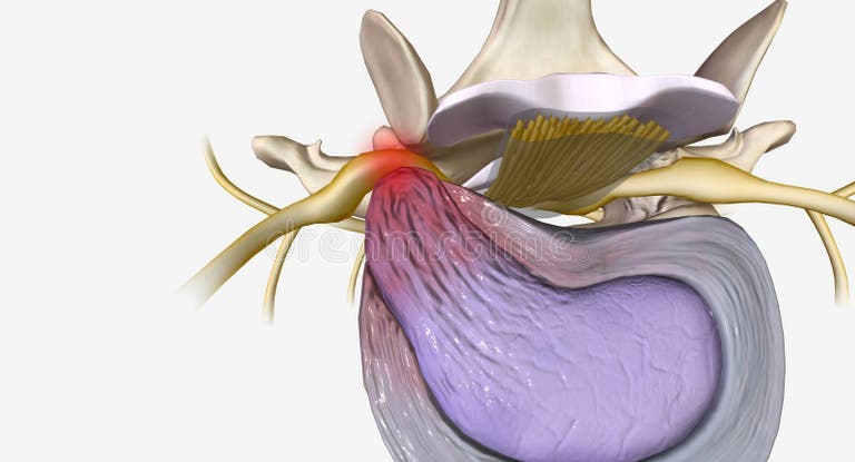 A Herniated Disc is a Condition Characterized by Structural Changes To ...