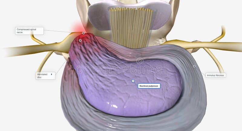 A Herniated Disc is a Condition Characterized by Structural Changes To ...