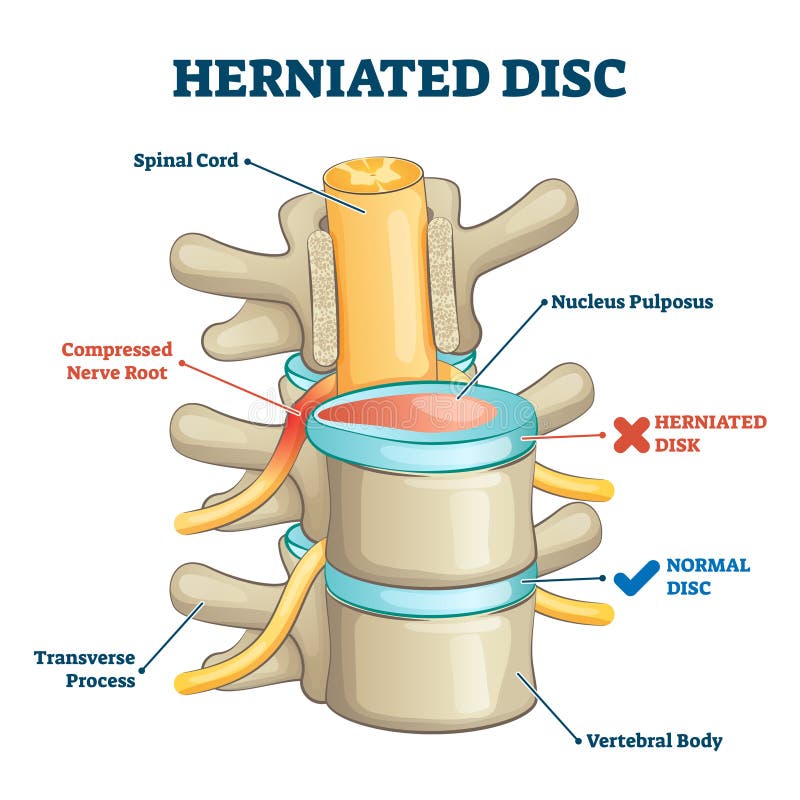 Herniated Disc Stock Illustrations – 1,103 Herniated Disc Stock ...