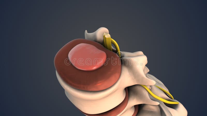 Herniated Disc of the Lumbar Spine Stock Illustration - Illustration of ...