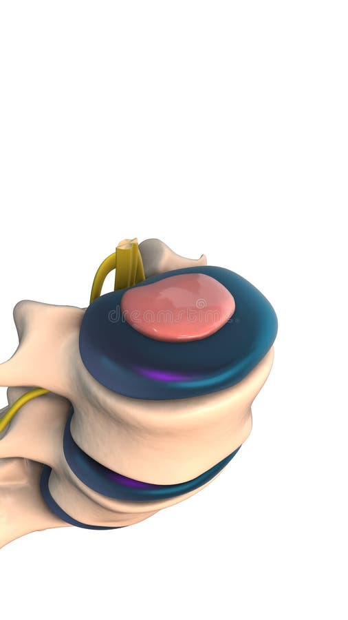 Slipped Disk or a Ruptured Disk Stock Illustration - Illustration of ...