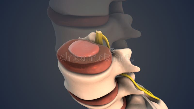 Herniated Disc of the Lumbar Spine Stock Illustration - Illustration of ...