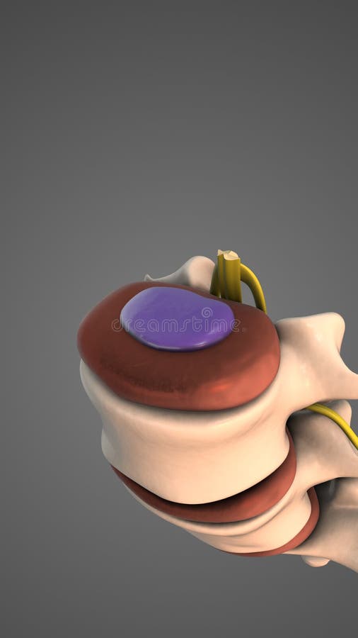 Herniated Disc in Lumbar Vertebrae Stock Illustration - Illustration of ...