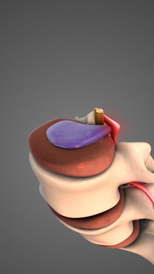 Herniated Disc in Lumbar Vertebrae Stock Illustration - Illustration of ...