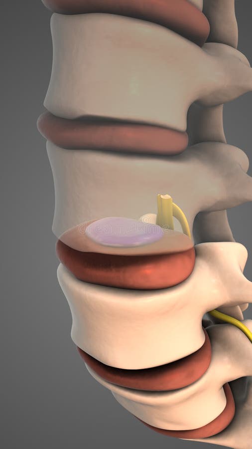 Herniated Disc in Lumbar Vertebrae Stock Image - Image of lumbar ...