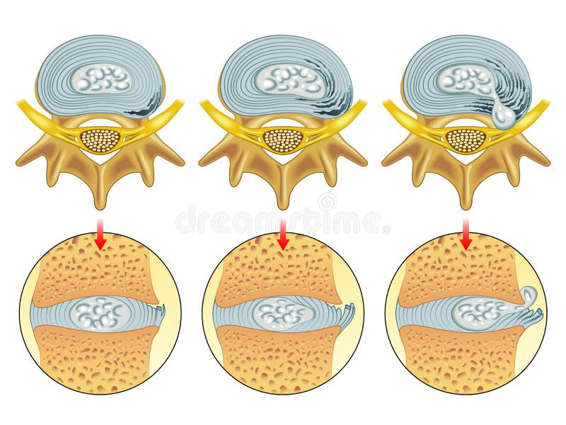 Herniated disc stock vector. Illustration of root, compression - 34671608