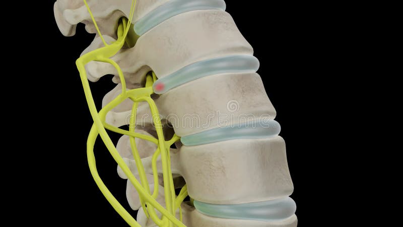 A Herniated Disc Protrusion Enlarges Compressing a Nerve Root and ...