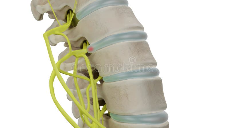 A Herniated Disc Protrusion Enlarges Compressing a Nerve Root and ...