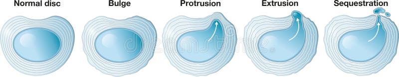 Herniated Disc Schema. Normal Disc. Bulge. Protusion. Extrusion ...