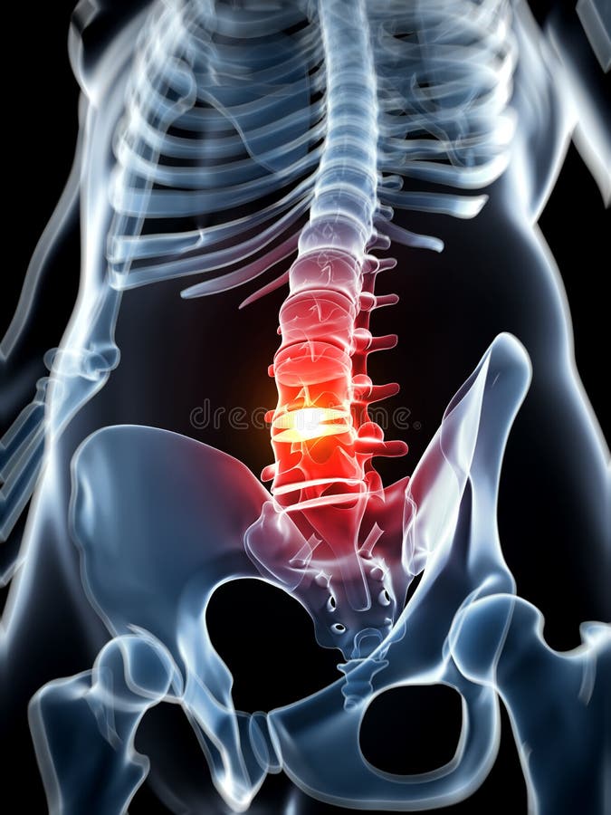 Herniated disk stock illustration. Illustration of nucleus - 30721851