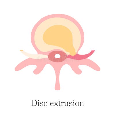 Ruptured Disk Stock Illustrations – 30 Ruptured Disk Stock ...