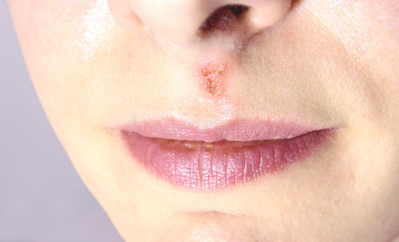 Zona Sur Le Visage Et Autour De L'oeil Appelé Herpès Ophtalmique Zoster ...