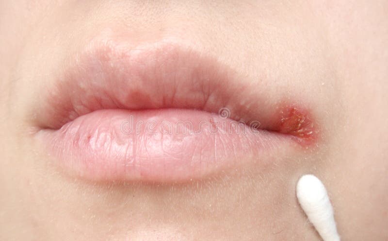 Herpes in the Corner of the Lips Stock Image - Image of healthcare ...