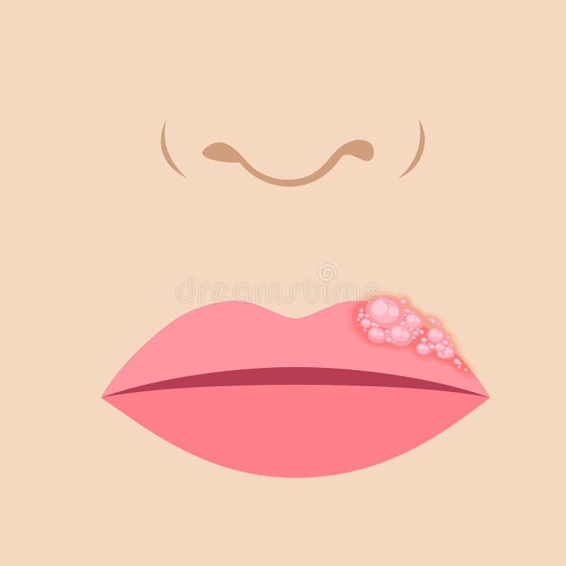 Problemas De Labios. Herpes Simple Y Angulus Infectiosus. Cuidado Y ...