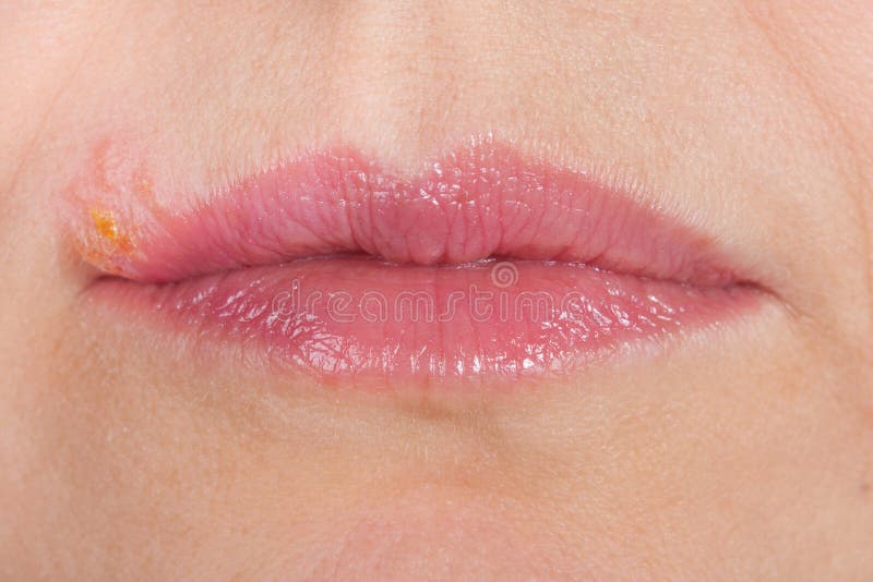 Bump On Lip: Causes, Treatment, And When To See A Doctor, 42% OFF
