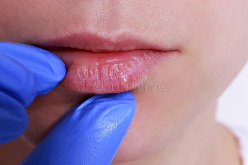 Herpes on the lips stock image. Image of cold, disgusting - 116258399