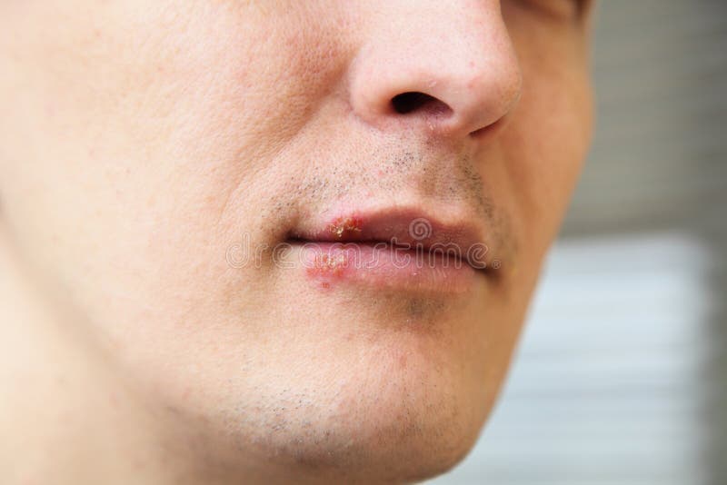 Herpes on the lips stock image. Image of medicine, indian - 52993329