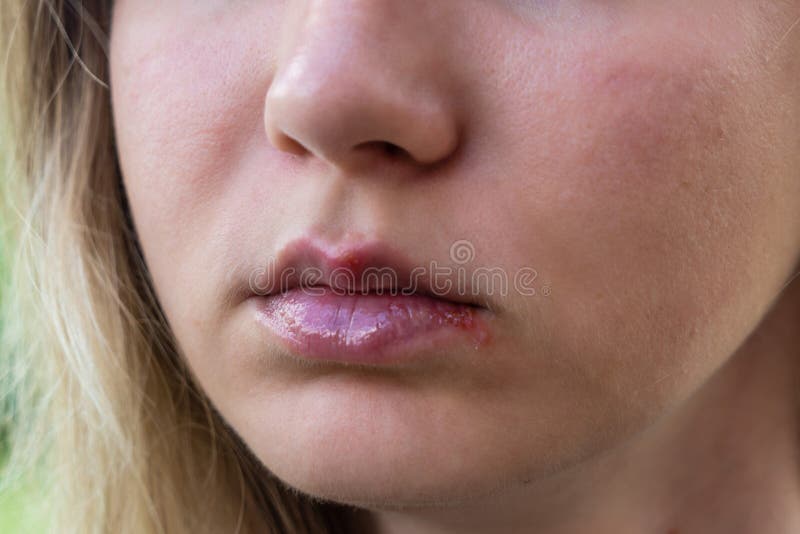 Herpes on the Lips of Young Woman. Close Up Stock Image - Image of ...