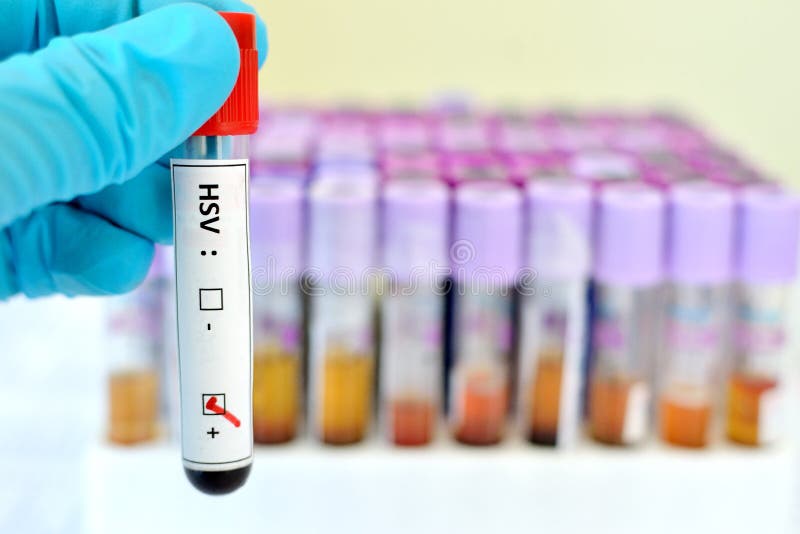 Herpes positive stock photo. Image of fever, hematology - 55735482