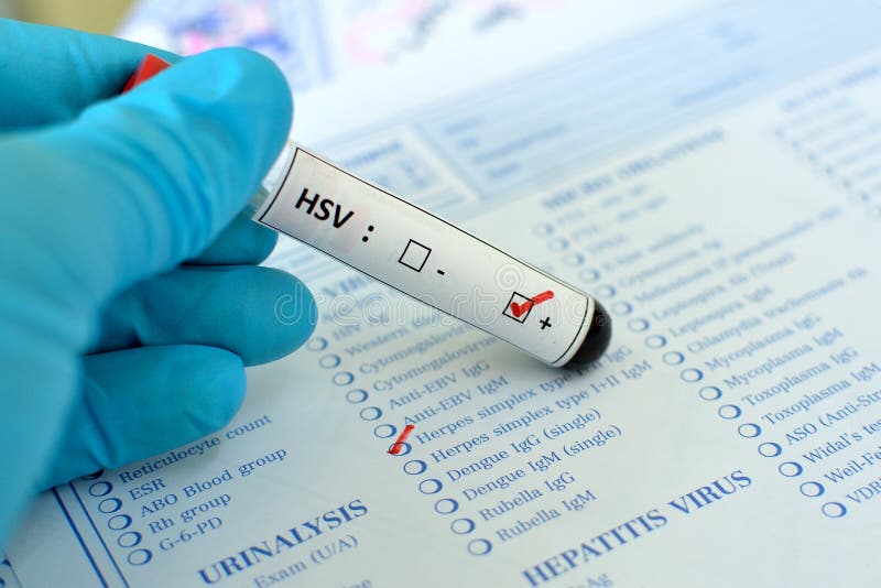 Herpes positive stock image. Image of organism, hospital - 55735495