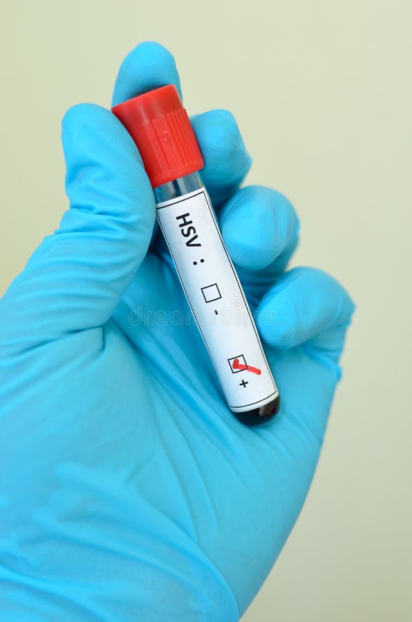 Herpes positive stock photo. Image of biology, laboratory - 55735510