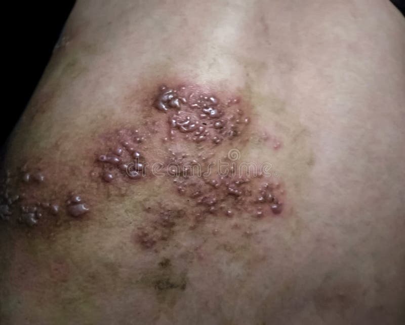 Herpes Simplex Infection at Back of a Patient. Small and Painful ...