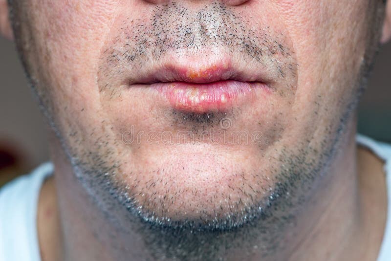 Herpes Virus Infection in a Man on the Lips Stock Photo - Image of ...