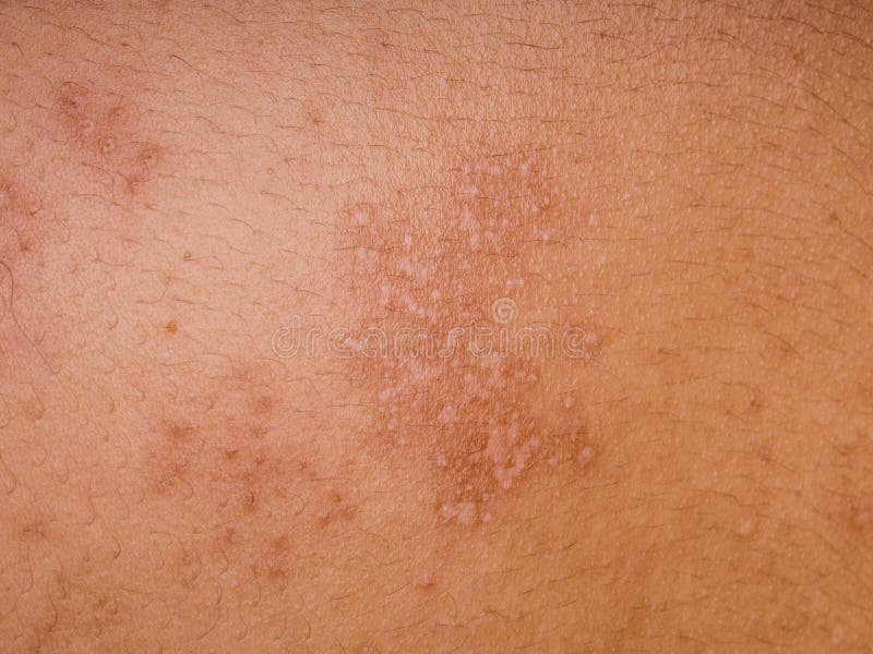 Herpes zoster stock photo. Image of epidermis, herpes - 105007172