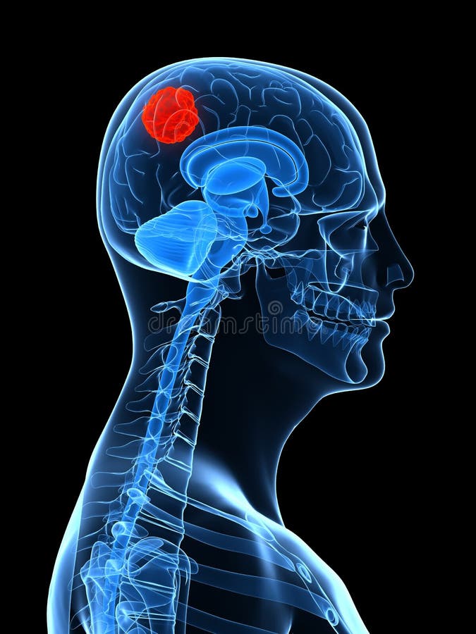 Hersen tumor stock illustratie. Illustration of neuron - 11898222