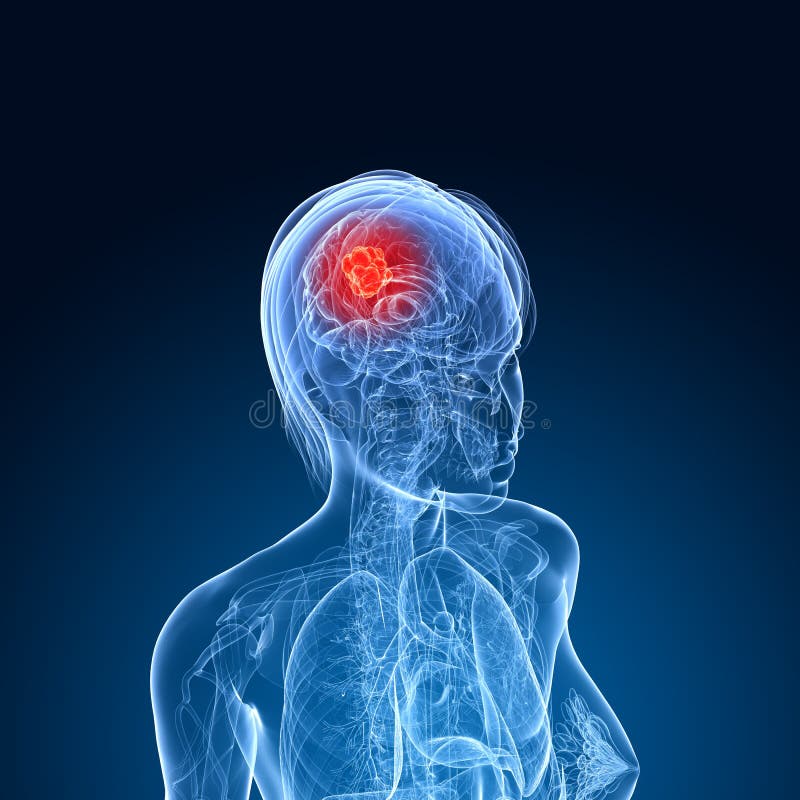 Hersen tumor stock illustratie. Illustration of kennis - 14409306