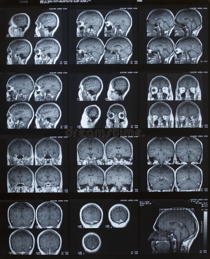 MRI-scan van de hersenen stock foto. Image of beeld, diagnose - 34023772