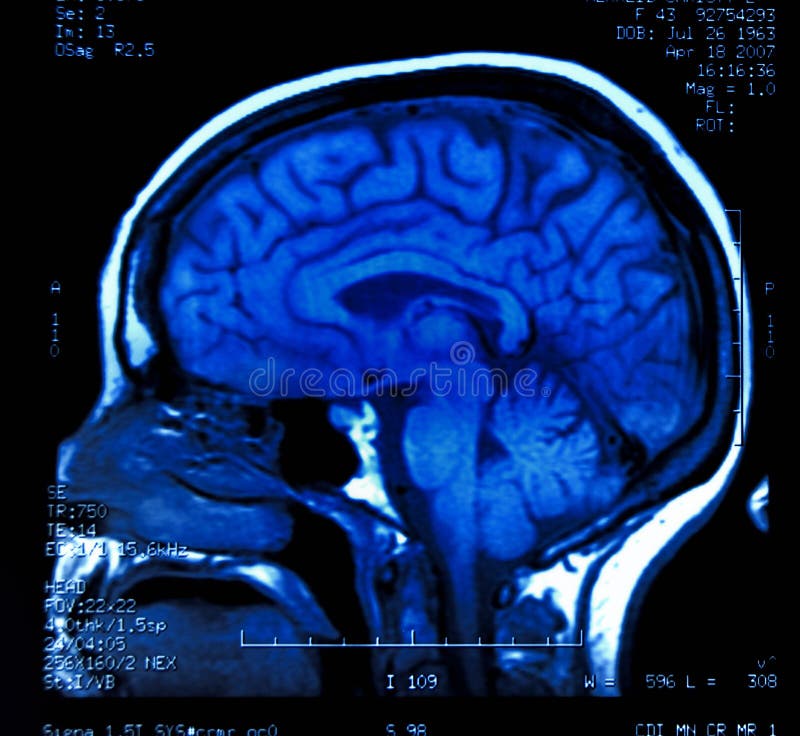 Hersenen MRI stock foto. Image of medisch, anatomie, weergave - 8117228