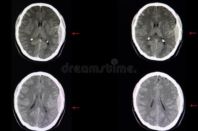 CT Hersenen Subacuut Subdural Hematoom Stock Foto - Image of hersen ...
