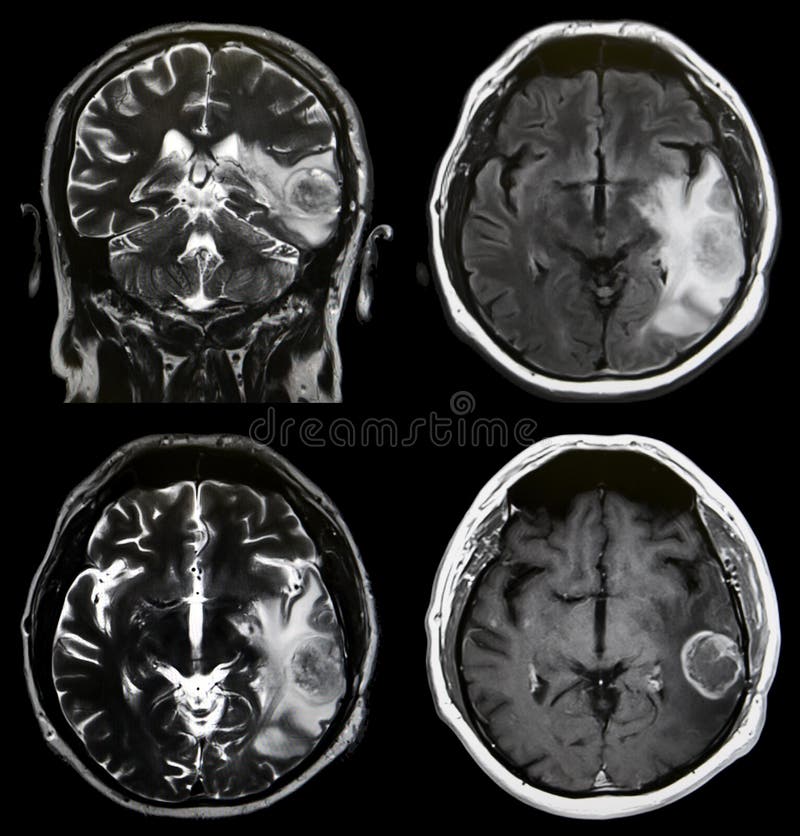 MRI Van Normale Menselijke Hersenenanatomie Stock Foto - Image of ...