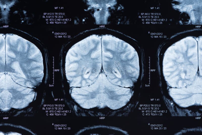 Mri scan hersenen stock foto. Image of ziekte, gezondheid - 177296330