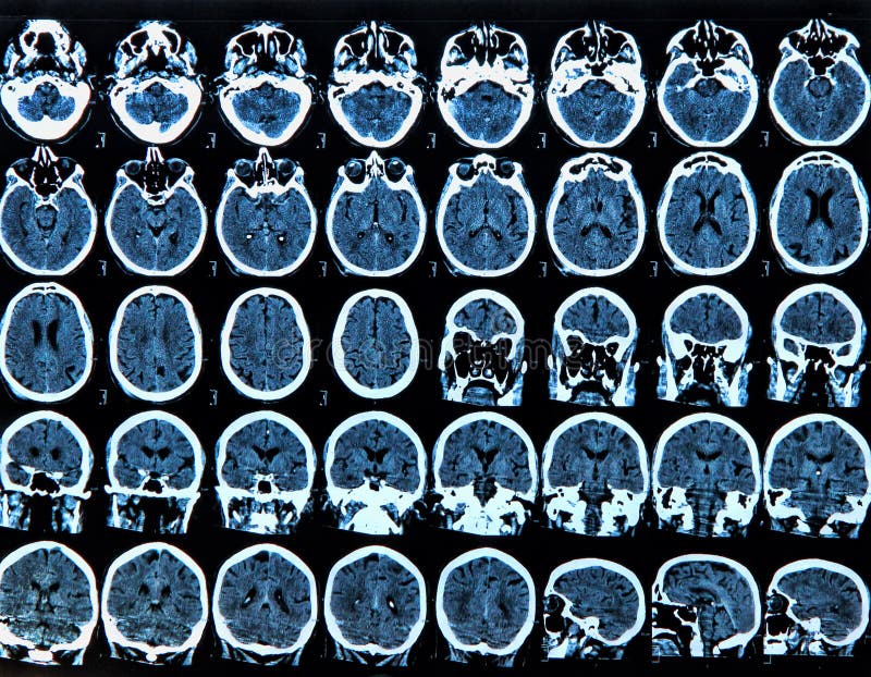 Het Aftasten Van De Hersenen Van Mri Redactionele Stock Foto - Image of ...