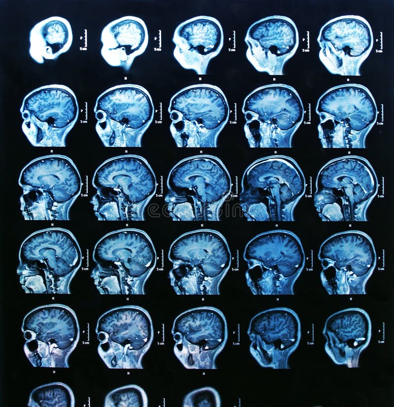 Het Aftasten Van Hersenen MRI Stock Afbeelding - Image of intelligentie ...