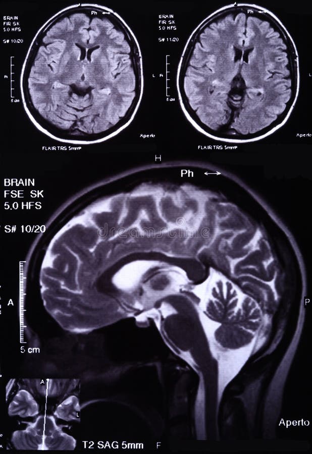 Mri Het Hersenmatig Perilesionaal Vasogeen Oedeem Met Een Middellijn ...