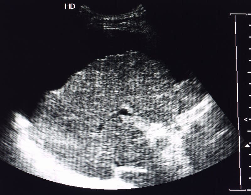 Het Beeld Van De Ultrasone Klank Van Levercirrose Stock Foto - Image of ...