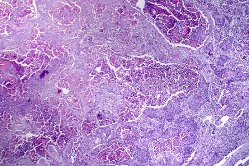 Het Carcinoom Van De Squamouscel Van De Long Stock Foto - Image of ...