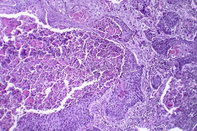 Plaveiselcelcarcinoom Van De Uterus Lichtmicrograaf Stock Foto - Image ...