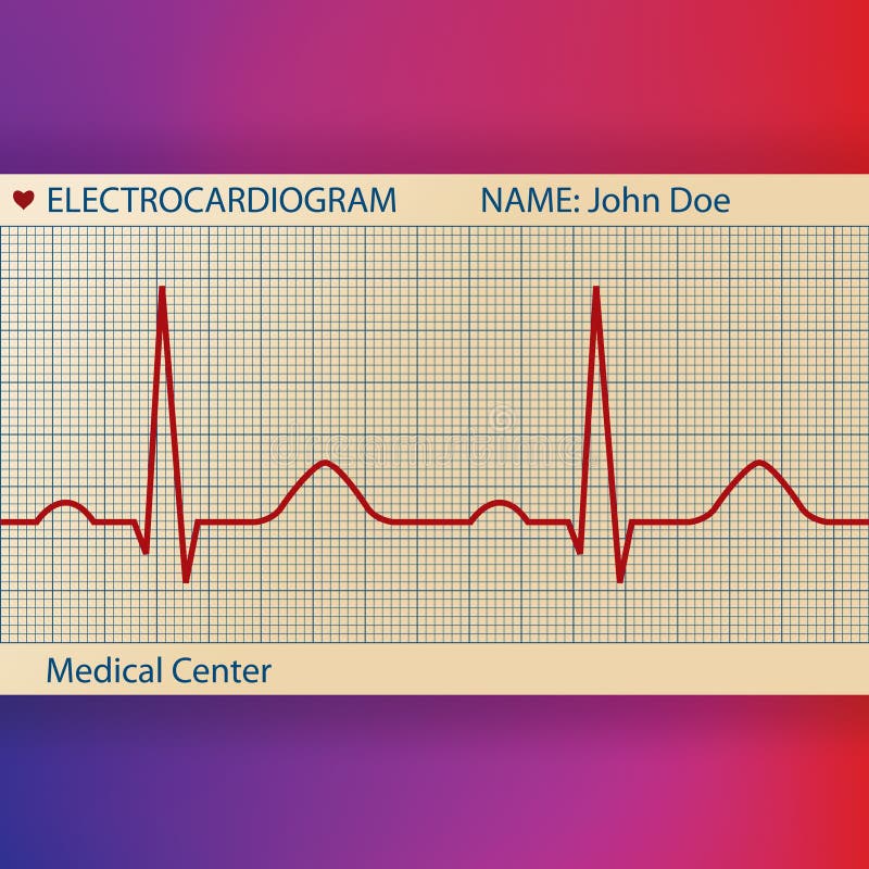 Het Document Van Het Elektrocardiogram Met Normale ECG Vector ...