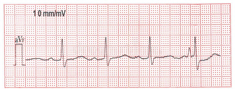 Het elektrocardiogram stock illustratie. Illustration of hart - 22186222