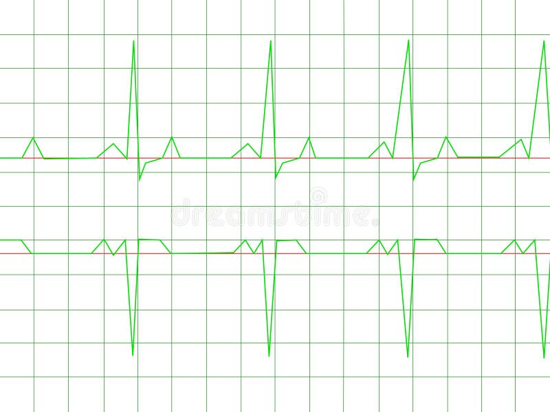 Normaal Hartritme stock illustratie. Illustration of diagnose - 9638502