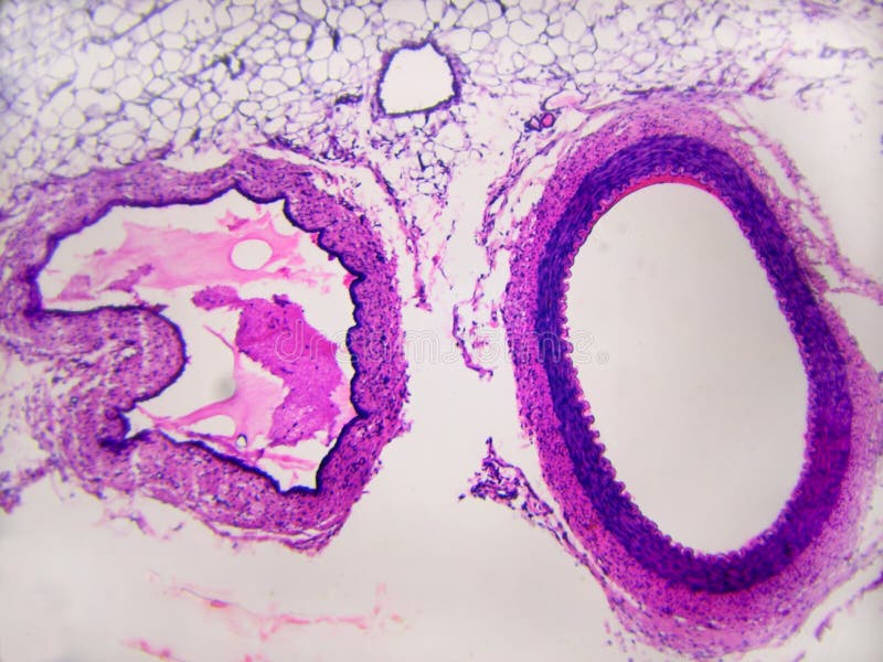 Slagader PK N4826 stock foto. Image of ziekte, anatomie - 3942518