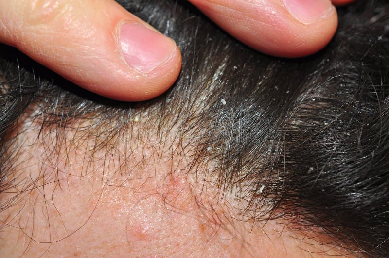 Psoriasis Vulgaris Psoriatica Huidaandoening in Het Hoofd Van De Huid ...