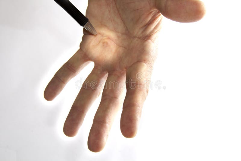 Hand Van Een Mens Met Dupuytren-contractuur Op Blauw Stock Afbeelding ...