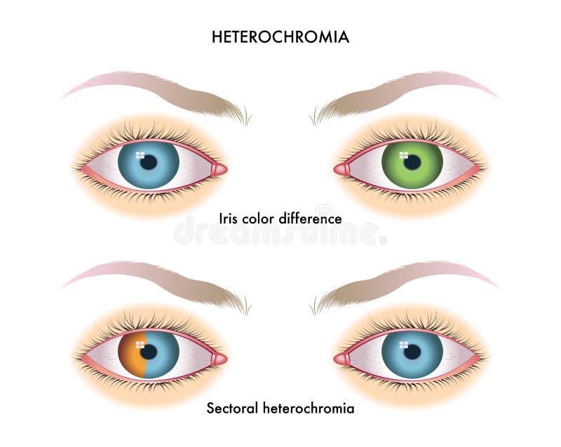Heterochromia der Iris vektor abbildung. Illustration von melanin ...